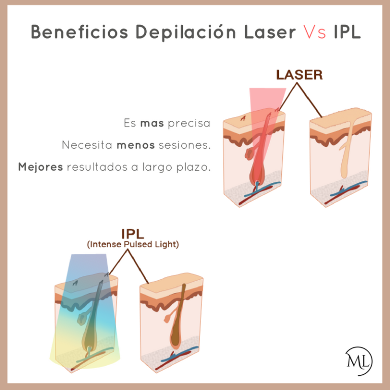 Depilacion Definitiva, Que es y Como Funciona - Dra. Maria Lucchesi