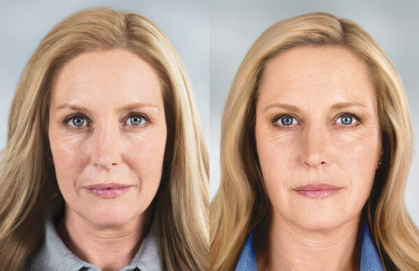 Sculptra - Recupera el volumen y firmeza en la piel - Buenos Aires